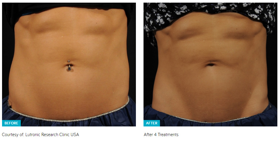 Accufit™ Body Sculpting - BioRestore Health