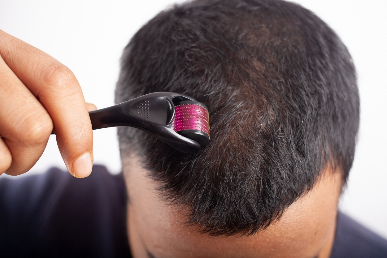 9 Microneedling Aftercare Tips from Hair Clinic Experts