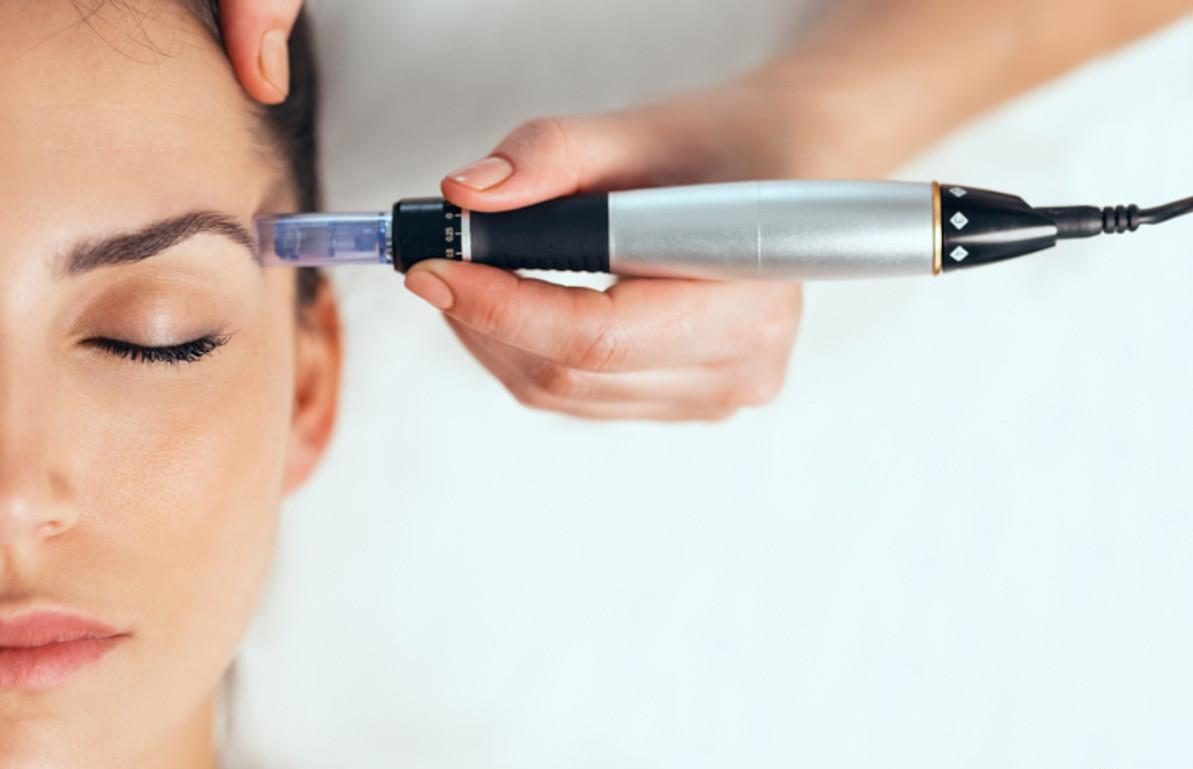 Microneedling for Hair Loss in Women: What to Know